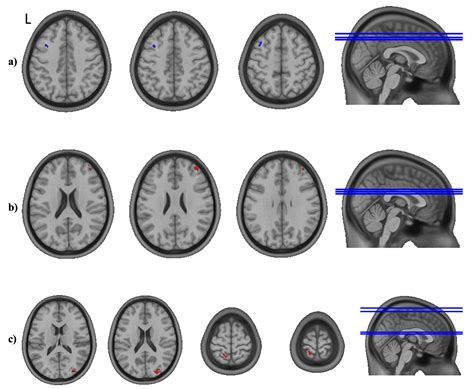 Physical Activity Alters Functional Connectivity Of Orbitofrontal Cortex Subdivisions In Healthy