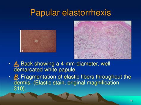 Ppt Elastic Tissue Disorders Powerpoint Presentation Free Download Id 1023203