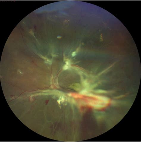 Neovascularization A Small Solution To A Big Problem