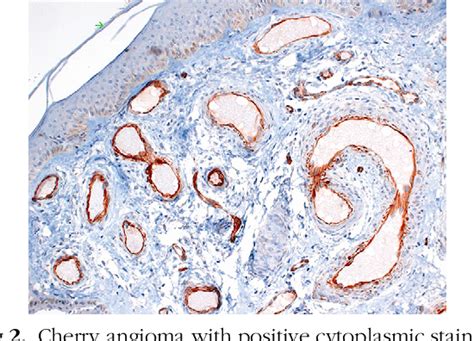 Hobnail Hemangioma Semantic Scholar