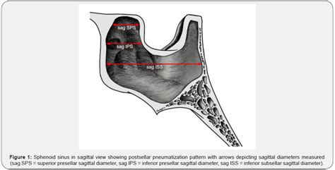 Mexican Sphenoid Sinus Radiological Anatomy High Risk Anatomy For