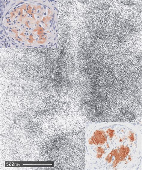 Typical Fibrillary Structure Of Amyloid Deposits On Transmission