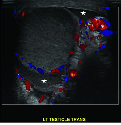 Imaging Testicular Torsion Applied Radiology