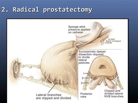 Bladder Outlet Obstruction Ppt