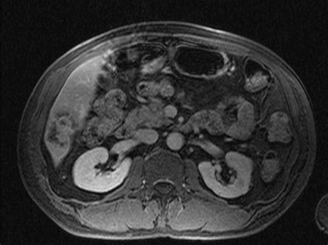 Cholangiocarcinoma Ct