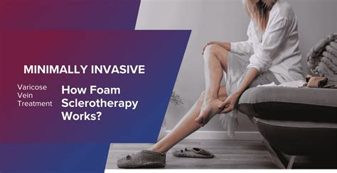 Minimally Invasive Varicose Vein Treatment