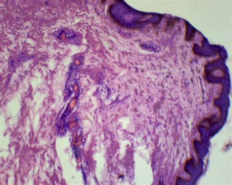 Pseudoxanthoma Elasticum Histology