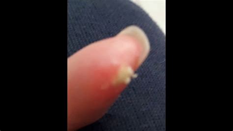 Calcinosis In Scleroderma Systemic Sclerosis Youtube