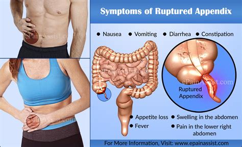 Ruptured Appendix Causes Symptoms Treatment Signs Complications