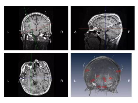 Ictal Eeg Source Imaging Pptx Brain And Nervous System Disorders