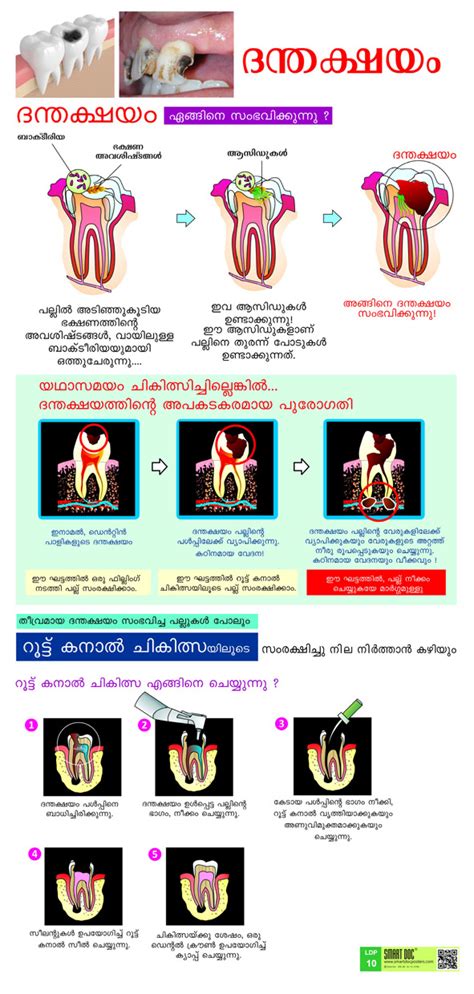 Dental Caries Progression