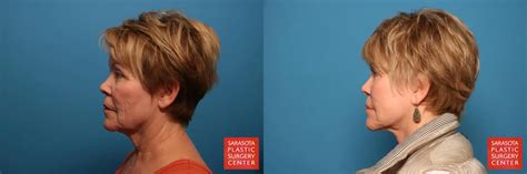 Laser Skin Resurfacing Face Before And After Gallery Patient 29