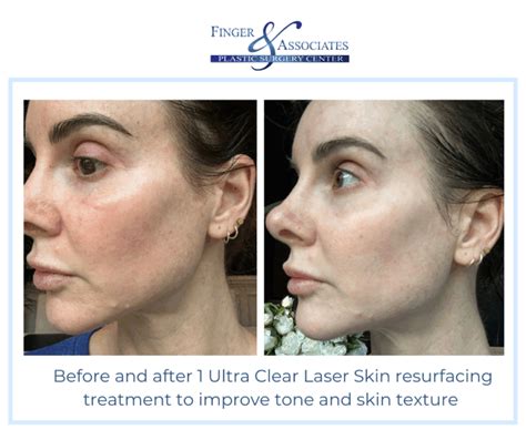 Ultraclear Laser Resurfacing Improves Texture Wrinkles