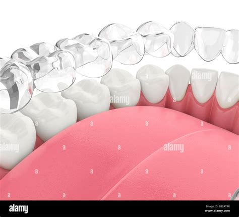 3d Render Of Invisalign Removable And Invisible Retainer With Lower Jaw Over White Background