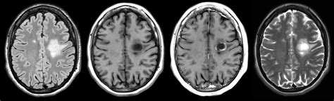 Mri Gadolinium Enhancing Lesions In Ms Clinical Trials