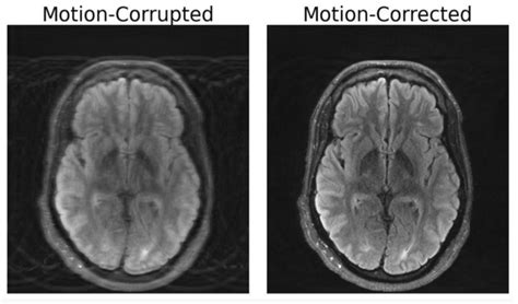 How To Fix Motion Corrupted Mri Scans Using Deep Learning And Physics