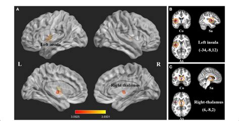 Figure E Statistical Parametric Maps Showing Decreased Gray Matter