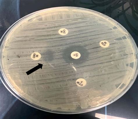 Double Disc Synergy Test 2 Positive Test Enhancement Of Zone Download Scientific Diagram