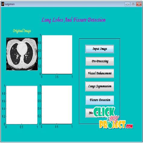 Segmentation Of Lung Lobes And Nodules In Ct Images Clickmyproject