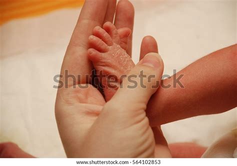 Psoriasis Newborn Photos Images And Pictures Shutterstock