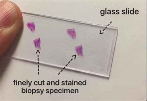 Preparing A Scalp Biopsy — Donovan Hair Clinic