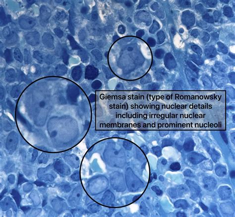 Morphologic Features Of Acute Lymphoblastic Leukemia B All Involving