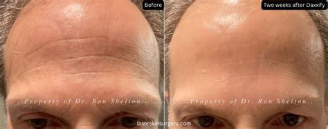 Daxxify Vs Botox Cosmetic To Reduce Forehead Frown Lines In NYC