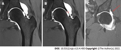 Capsulotomy Joint At Stanley Call Blog