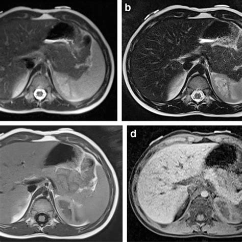 Striated Nephrogram As A Normal Variant In A 12 Year Old Girl Download Scientific Diagram