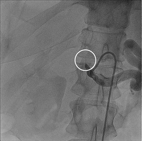 Selective Angiography Of The Common Hepatic Artery After Liver
