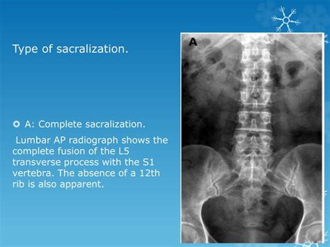 Transitional Vertebrae Radiology Pptx