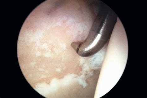 Amic Hip Geistlich Pharma Ag