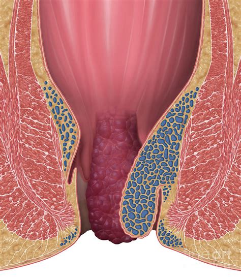 Vaginal Hemorrhoid