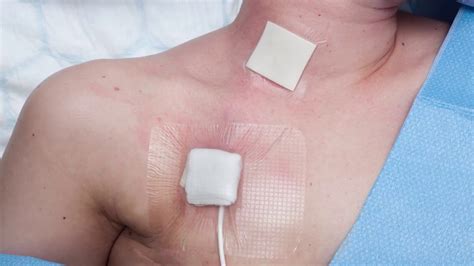 Central Venous Catheters Are Used For Iv Treatment Of Which Fluid At