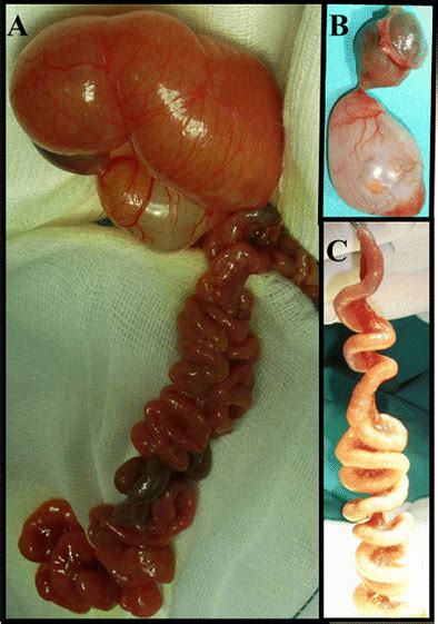 High Jejunal Multiple Intestinal Atresia A Type Ii Atresia B Type