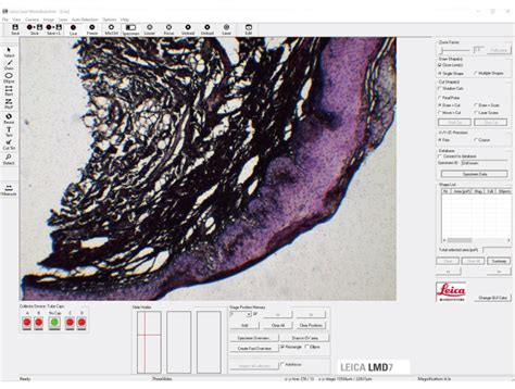 Isolation Of Cells With Morphological And Spatial Information From Oral Submucous Fibrosis