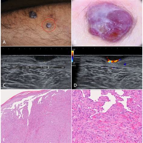 Nodular Kaposis Sarcoma A Hyperkeratotic Nodules On The Left