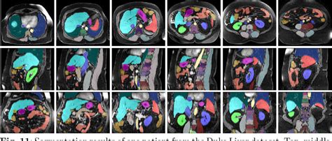 Figure 11 From Mrisegmentator Abdomen A Fully Automated Multi Organ And Structure Segmentation
