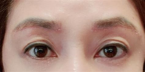 눈썹밑거상술 후 지식in