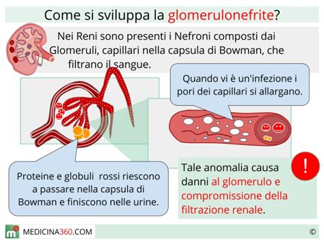 Glomerulonefrite Acuta O Cronica Sintomi Cause E Cura