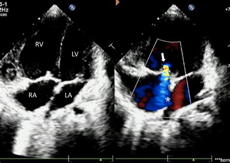 Transthoracic Echocardiogram The Four Chamber View Of Cardiac Download Scientific Diagram