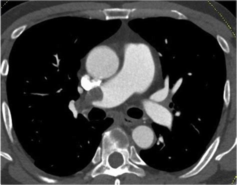 Left Upper Lobe Trisegmentectomy After Pulmonary Endarterectomy The Annals Of Thoracic Surgery