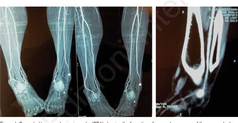 Figure 1 From Pseudoaneurysm Of Peroneal Artery After Ankle Arthroscopy Semantic Scholar