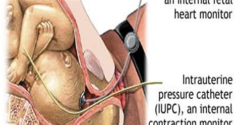 Baseline Fetal Heart Rate Analysis Album On Imgur