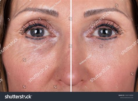Wrinkles Before After Images Stock Photos Vectors Shutterstock