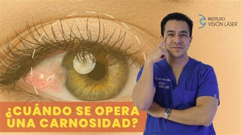Maneras efectivas para eliminar la carnosidad del ojo | Actualizado junio 2025