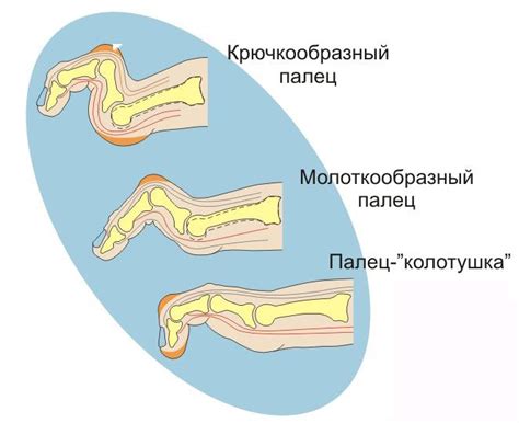 Молоткообразная деформация пальцев