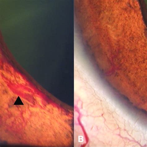 Pdf Intracameral Avastin Dramatically Resolves Iris Neovascularization And Reverses