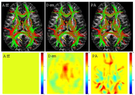 Top Row 3d Renderings Of The Registered Tracts Of A Subject In Green
