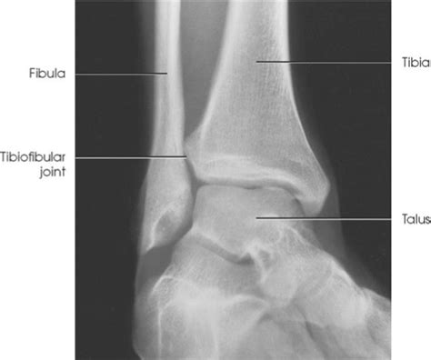Normal Pediatric Ankle Xray